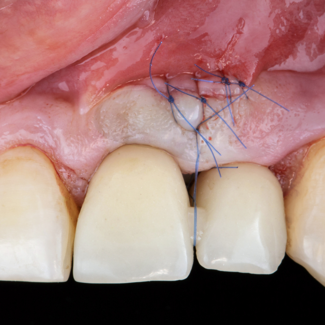 Root Coverage - Armadale Dental