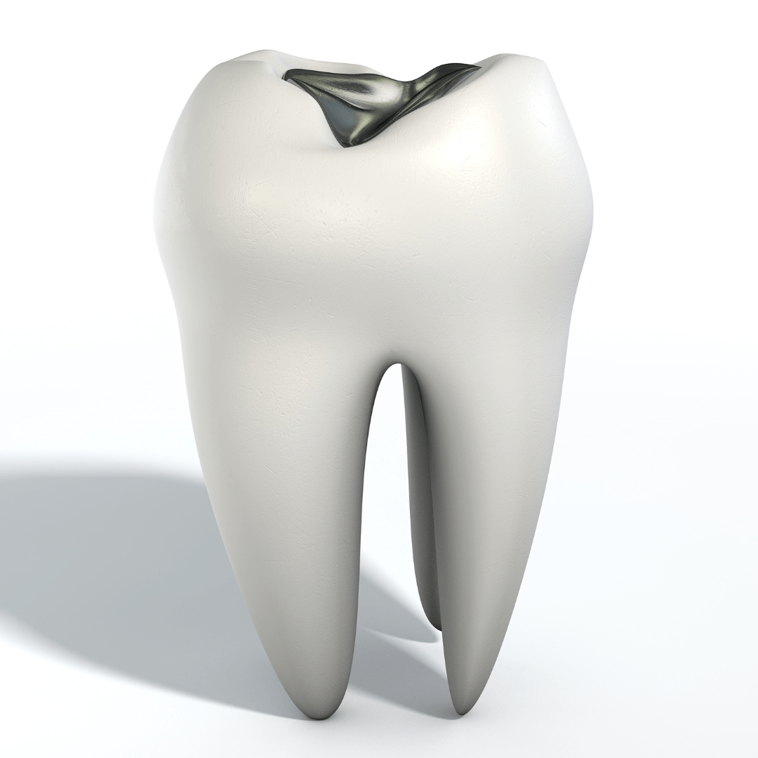 Tooth Colored Restoration - Armadale Dental