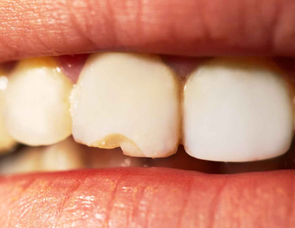 Repairing a Chipped or Broken Tooth: A Comprehensive Guide - Armadale ...