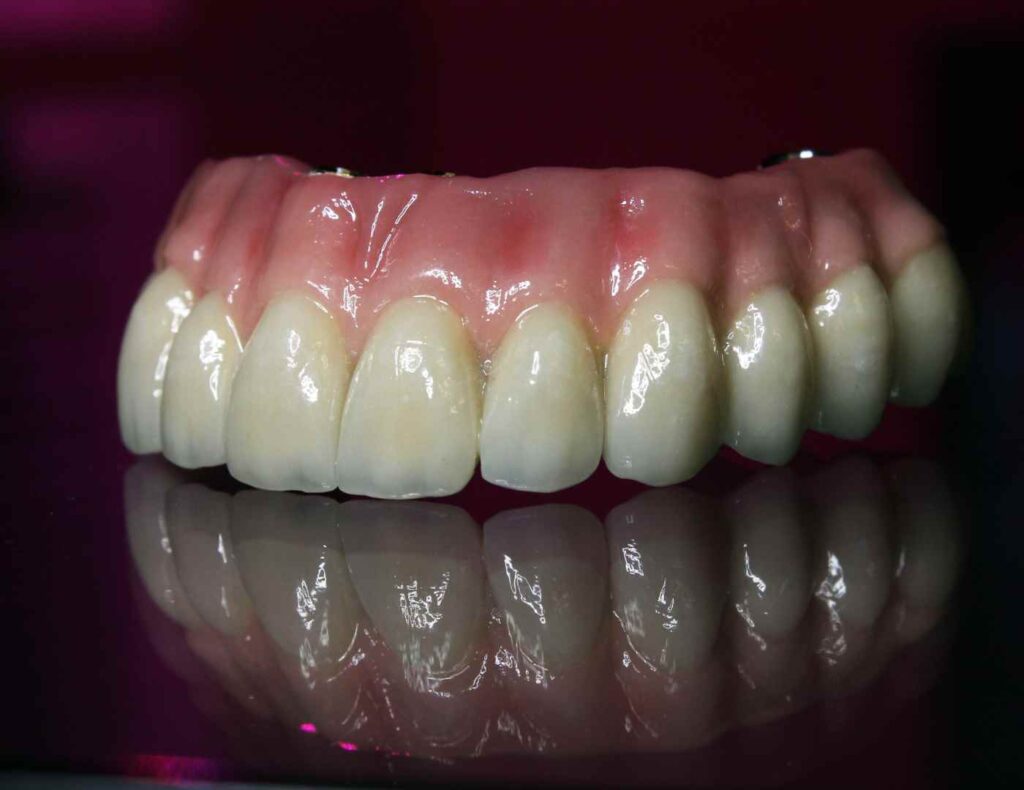 What Are Denture Implants? A Comprehensive Guide to Implant-Supported ...