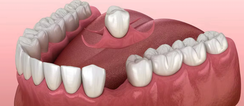 One Tooth Partial Denture - Armadale Dental